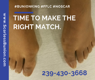 Minimally Invasive Bunion Surgery
