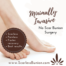 Minimally Invasive Bunion Surgery